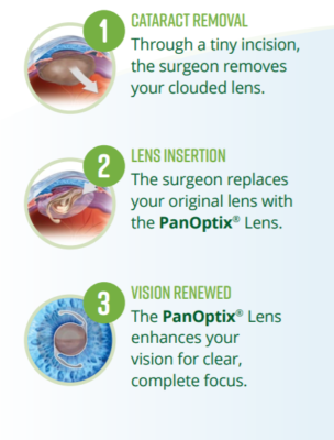What Is The PanOptix Trifocal IOL? | Sugiki Portis Yim